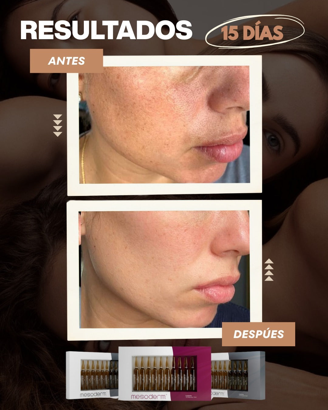Tratamiento Facial Bioestimulador + Antimanchas | PRDN + Liposculpt ...